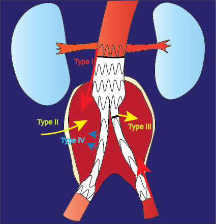 Aortic endoleaks - Critical Care Sonography