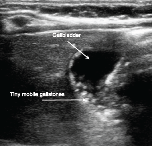Gallstones in 4 month old - Critical Care Sonography