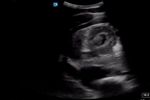 Intussusception - The doughnut sign or target sign, the pseudokidney ...