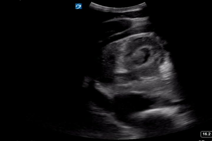 Intussusception - The doughnut sign or target sign, the pseudokidney ...