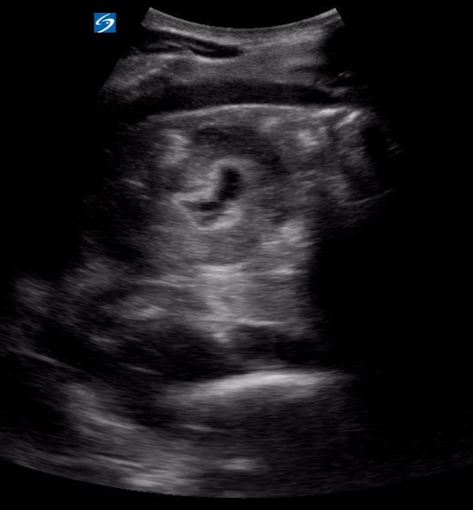 Intussusception - The doughnut sign or target sign, the pseudokidney ...