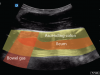 Intussusception - The doughnut sign or target sign, the pseudokidney ...