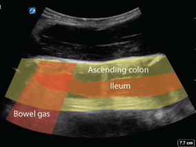 Intussusception - The doughnut sign or target sign, the pseudokidney ...