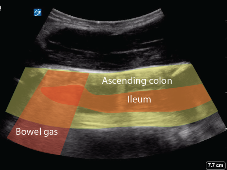 Intussusception - The doughnut sign or target sign, the pseudokidney ...