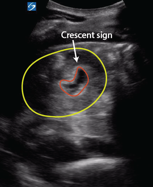Intussusception - The doughnut sign or target sign, the pseudokidney ...
