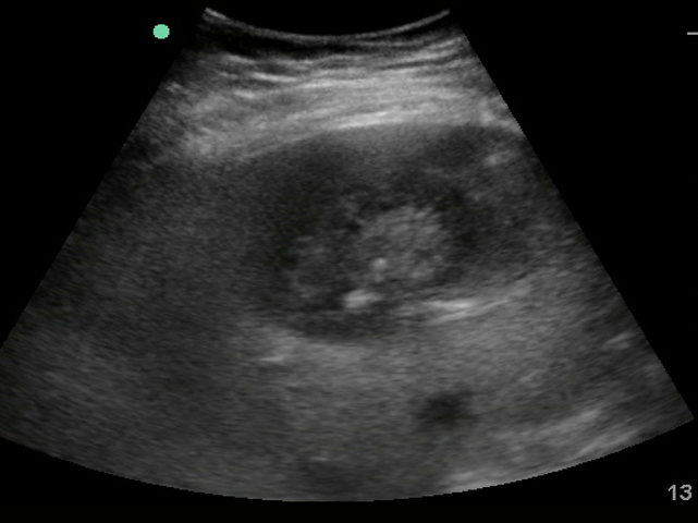Liver abscess – Critical Care Sonography