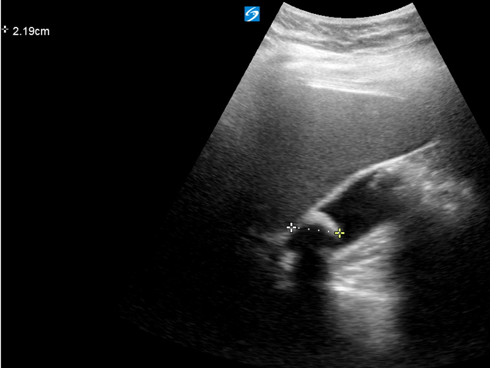 Gallstones - Critical Care Sonography