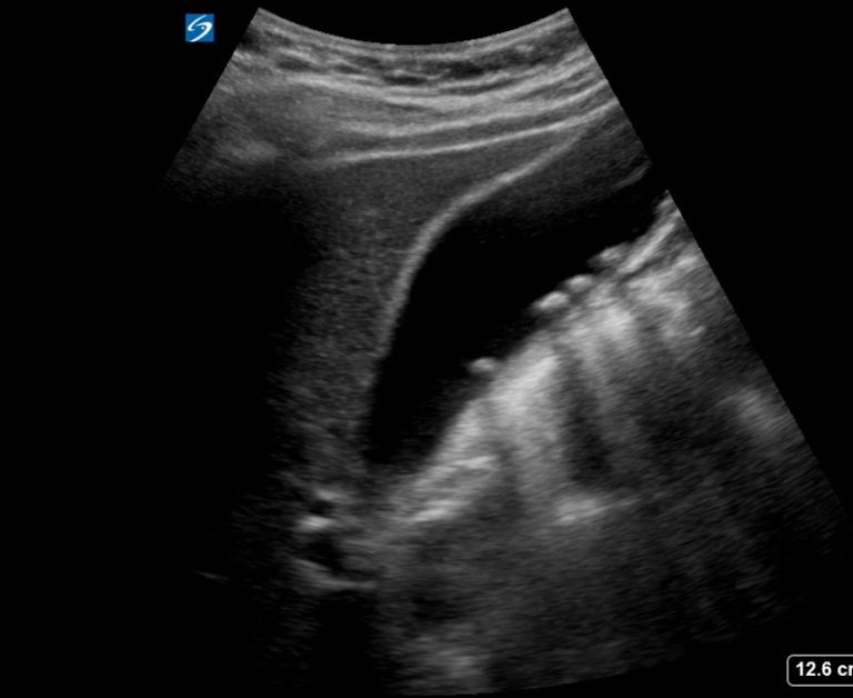 Gallstones - Critical Care Sonography