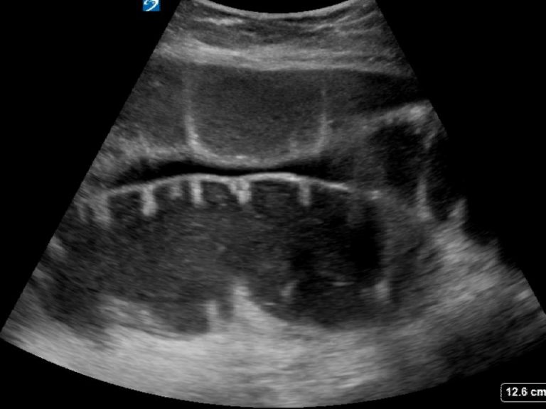 Bowel obstruction - Critical Care Sonography
