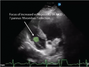 FB on AICD - Critical Care Sonography