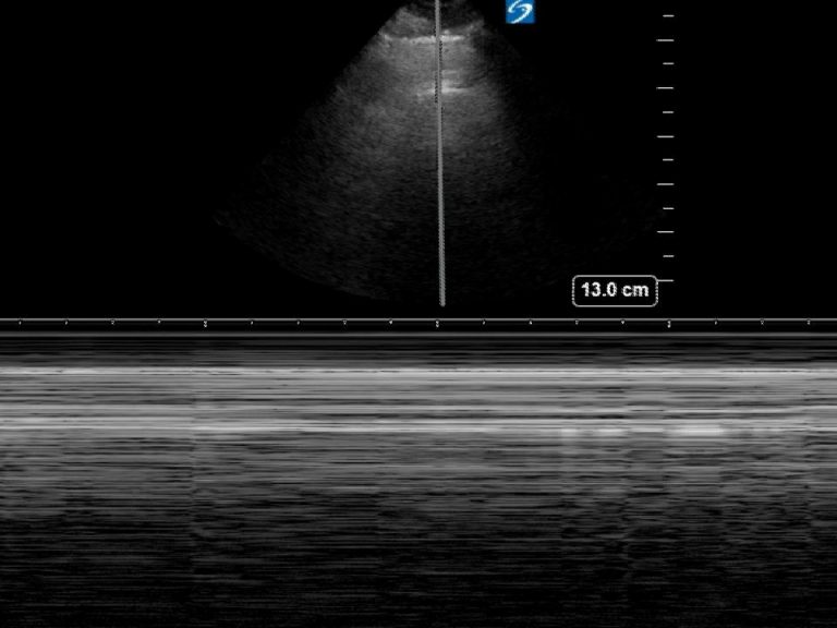 EFAST Archives - Critical Care Sonography