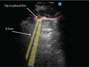 Normal chest Xray small area of consolidation and small pleural ...