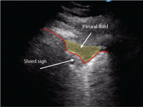 Consolidation - Critical Care Sonography