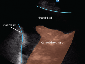 LLL consolidation - Critical Care Sonography