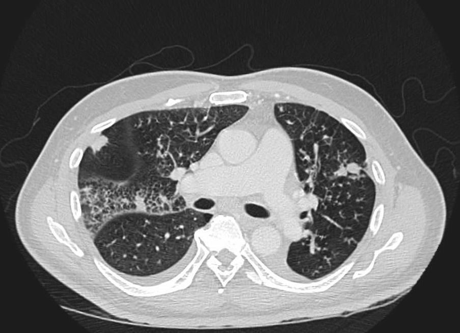 TB cardiomyopathy - All done and dusted? - Critical Care Sonography