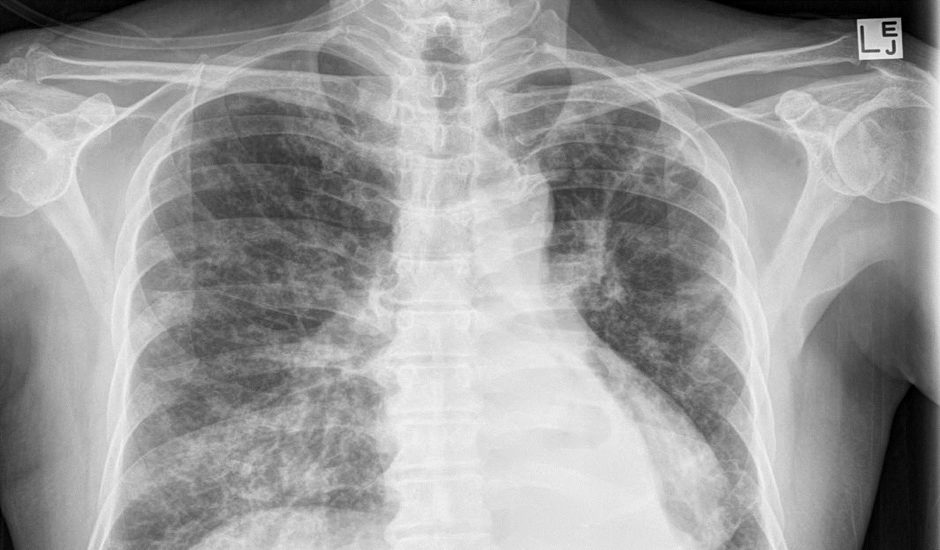 TB cardiomyopathy - All done and dusted? - Critical Care Sonography