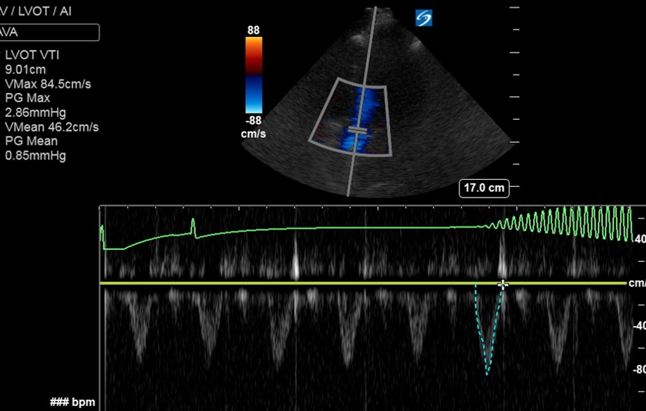TB cardiomyopathy - All done and dusted? - Critical Care Sonography