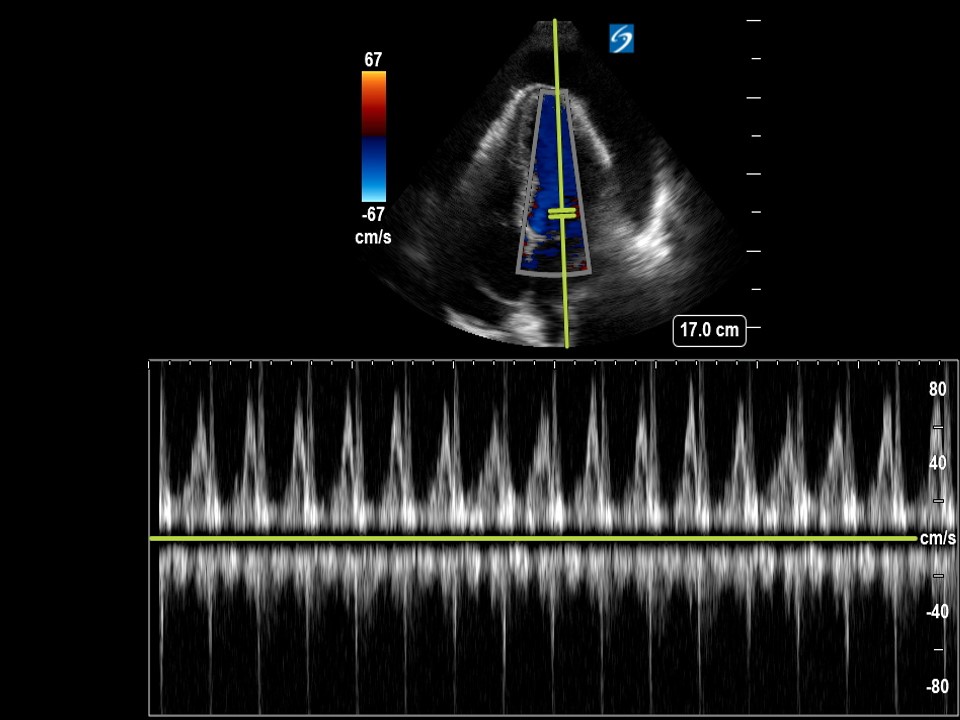 Large pericardial effusion - Critical Care Sonography