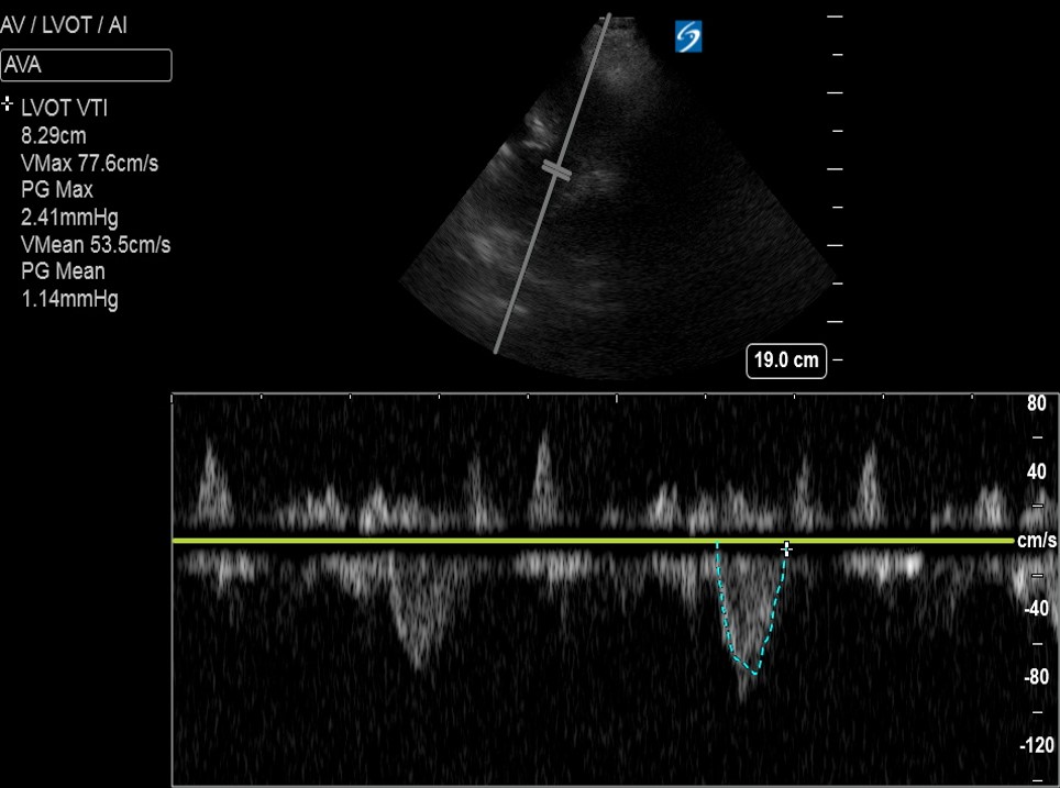 Anterior mitral valve prolapse - Critical Care Sonography