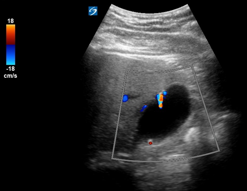 Pitfall - Stones in the gall bladder - Adenomyomatosis - Critical Care ...