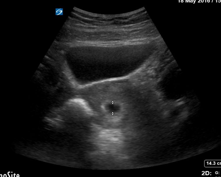 6 weeks, intrauterine gestational sac - Critical Care Sonography