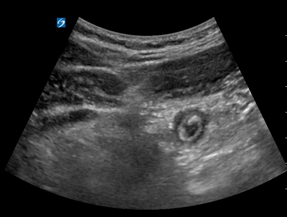 Appendicitis - appendicolith - Critical Care Sonography