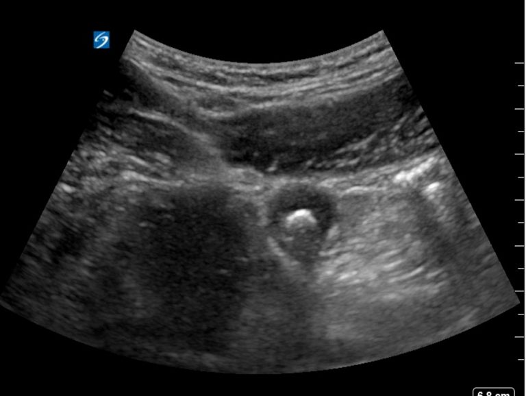 Appendicitis - appendicolith - Critical Care Sonography