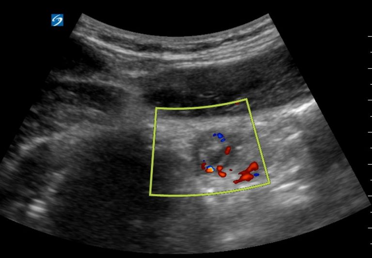 Appendicitis - appendicolith - Critical Care Sonography