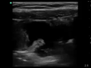 2 year old, ruptured appendix - Critical Care Sonography