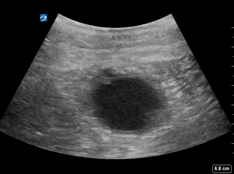 Deep buttock abscess. - Critical Care Sonography