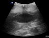 Deep buttock abscess. - Critical Care Sonography