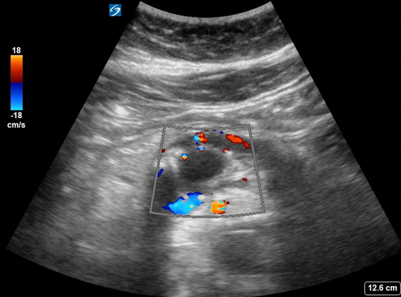 Pancreatic pseudocyst - Critical Care Sonography