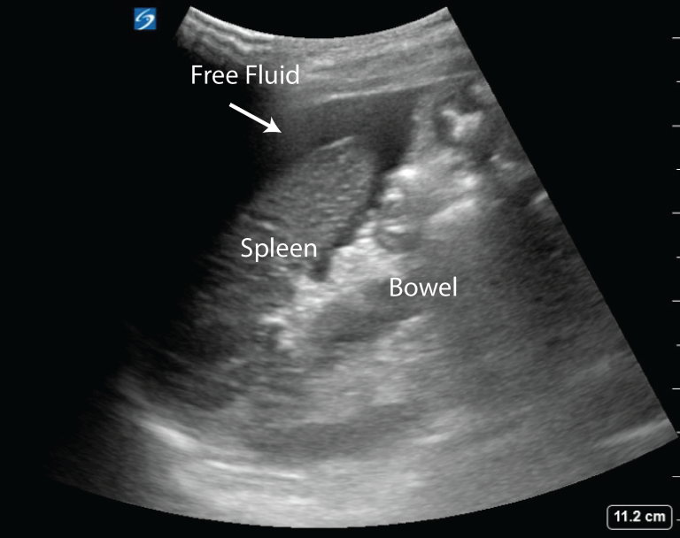 Ruptured liver - Critical Care Sonography