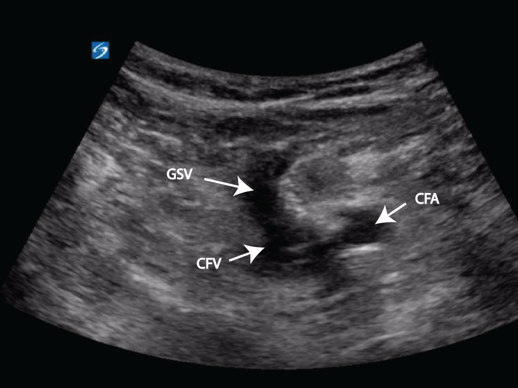 Thrombus CFV and GSV - Critical Care Sonography