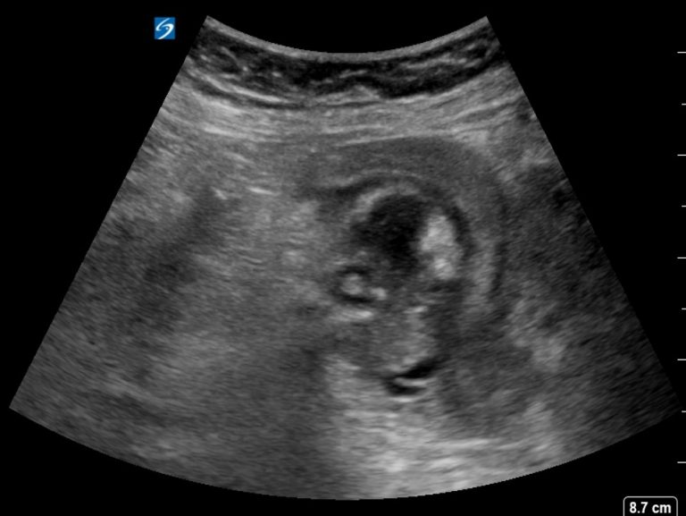 RIF pain - Critical Care Sonography