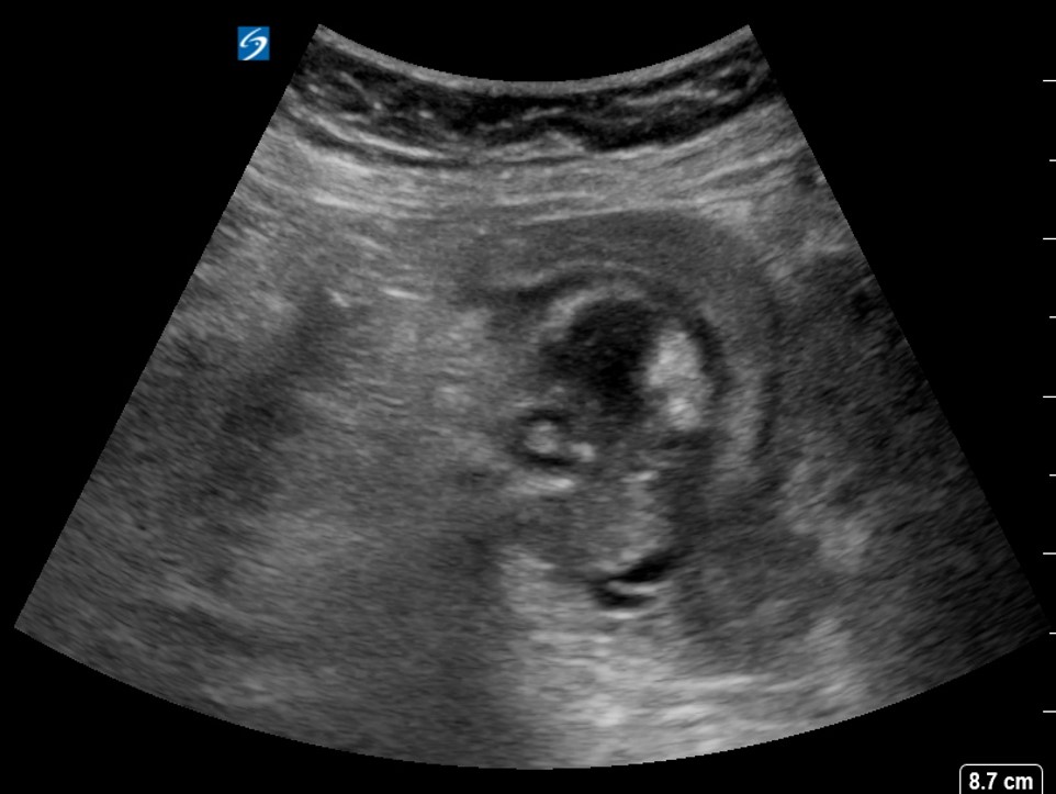 RIF pain - Critical Care Sonography