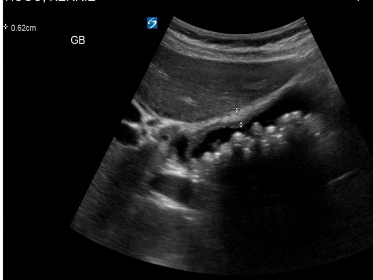 Choledocholithiasis - Critical Care Sonography