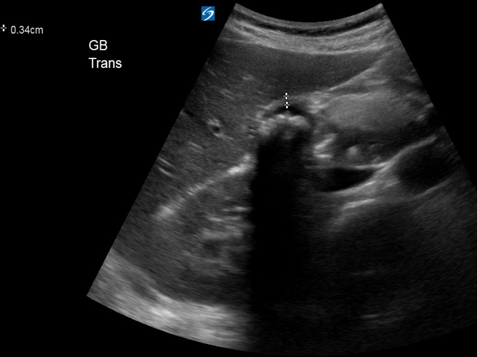 Choledocholithiasis - Critical Care Sonography