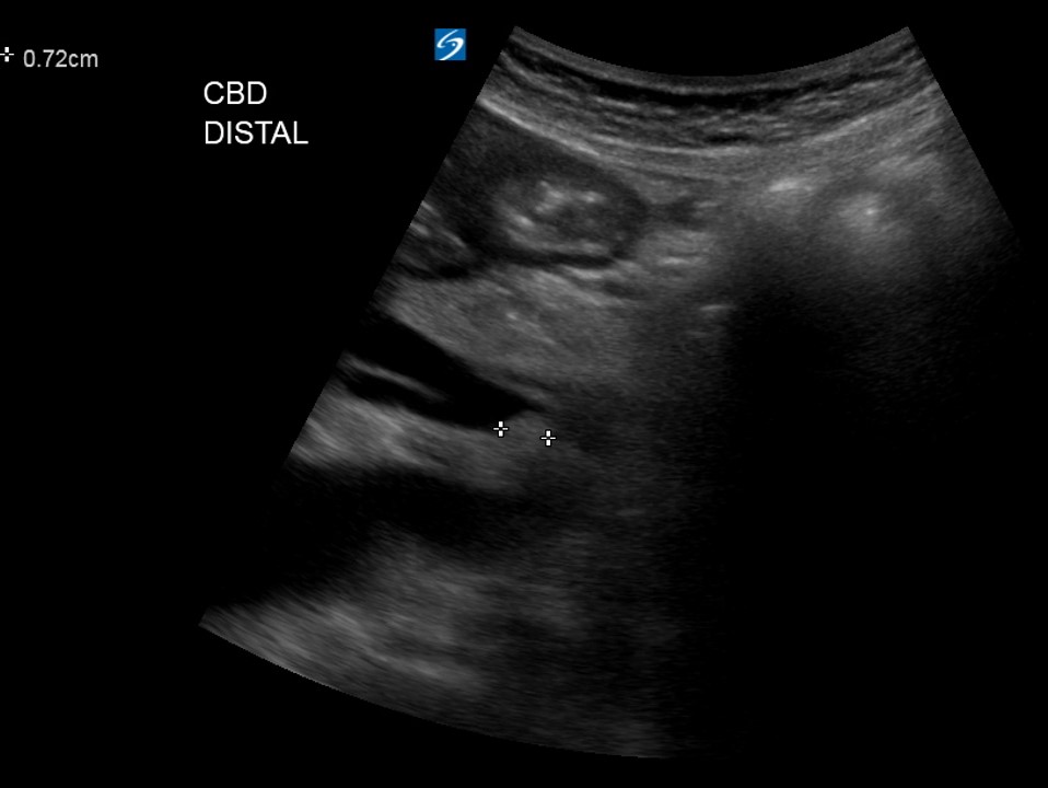 Choledocholithiasis – Critical Care Sonography