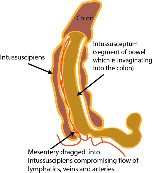 Intussusception - The doughnut sign or target sign, the pseudokidney ...