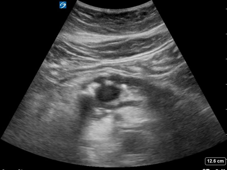 Pancreatic pseudocyst - Critical Care Sonography