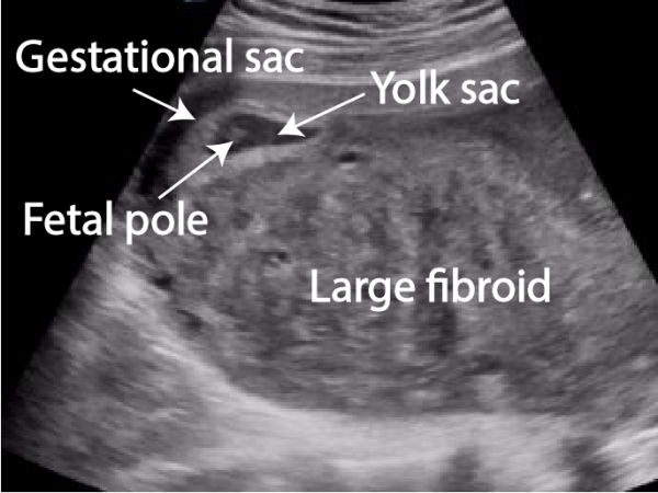 Very large uterine fibroid in patient with an early intrauterine ...