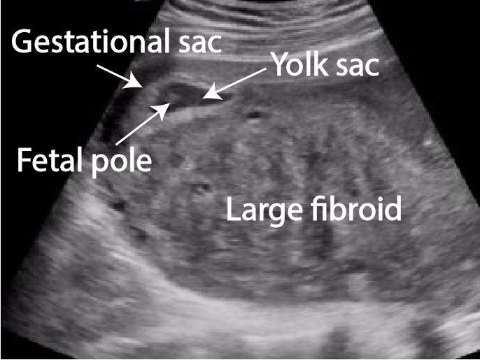 Very large uterine fibroid in patient with an early intrauterine ...