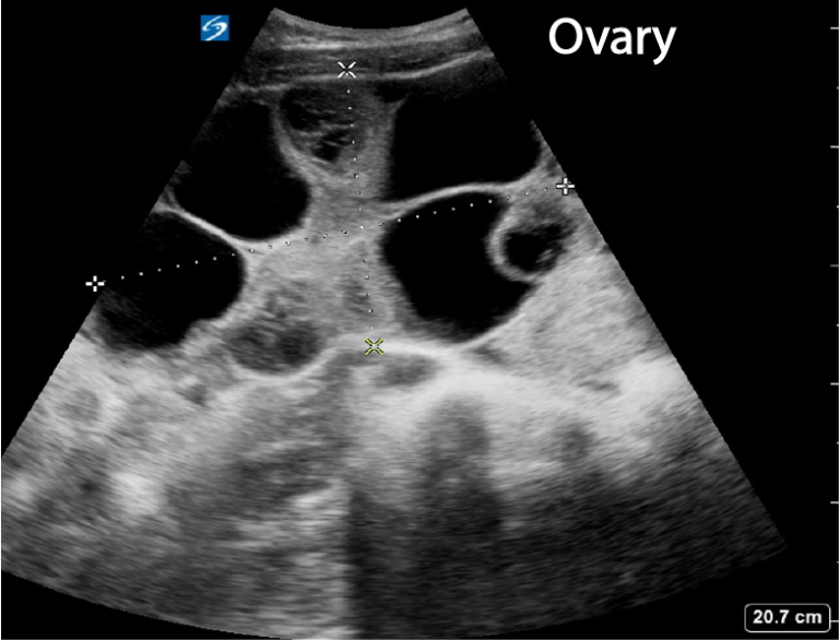 In vitro fertilisation, ovarian hyperstimulation syndrome, 4 weeks ...