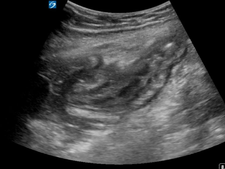 Appendicitis , right ovarian cyst - Critical Care Sonography