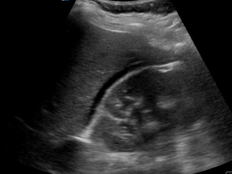 Ruptured ovarian cyst - Critical Care Sonography