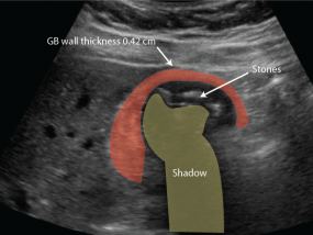Wall Echo Shadow - Critical Care Sonography