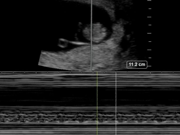 Subchorionic bleed,10 week pregnancy - Critical Care Sonography