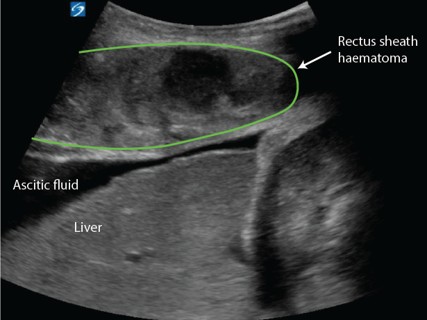 Abcesses / Nodes / Haematomas – Critical Care Sonography