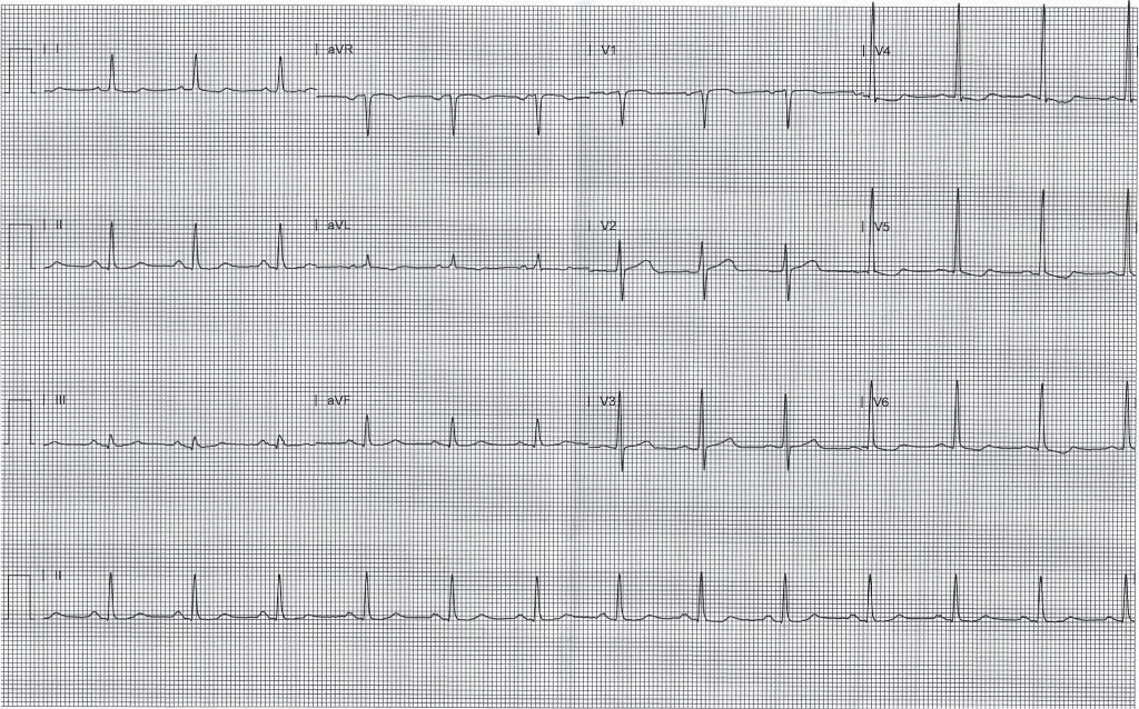 Shock - Left Ventricular Outflow Obstruction - Critical Care Sonography